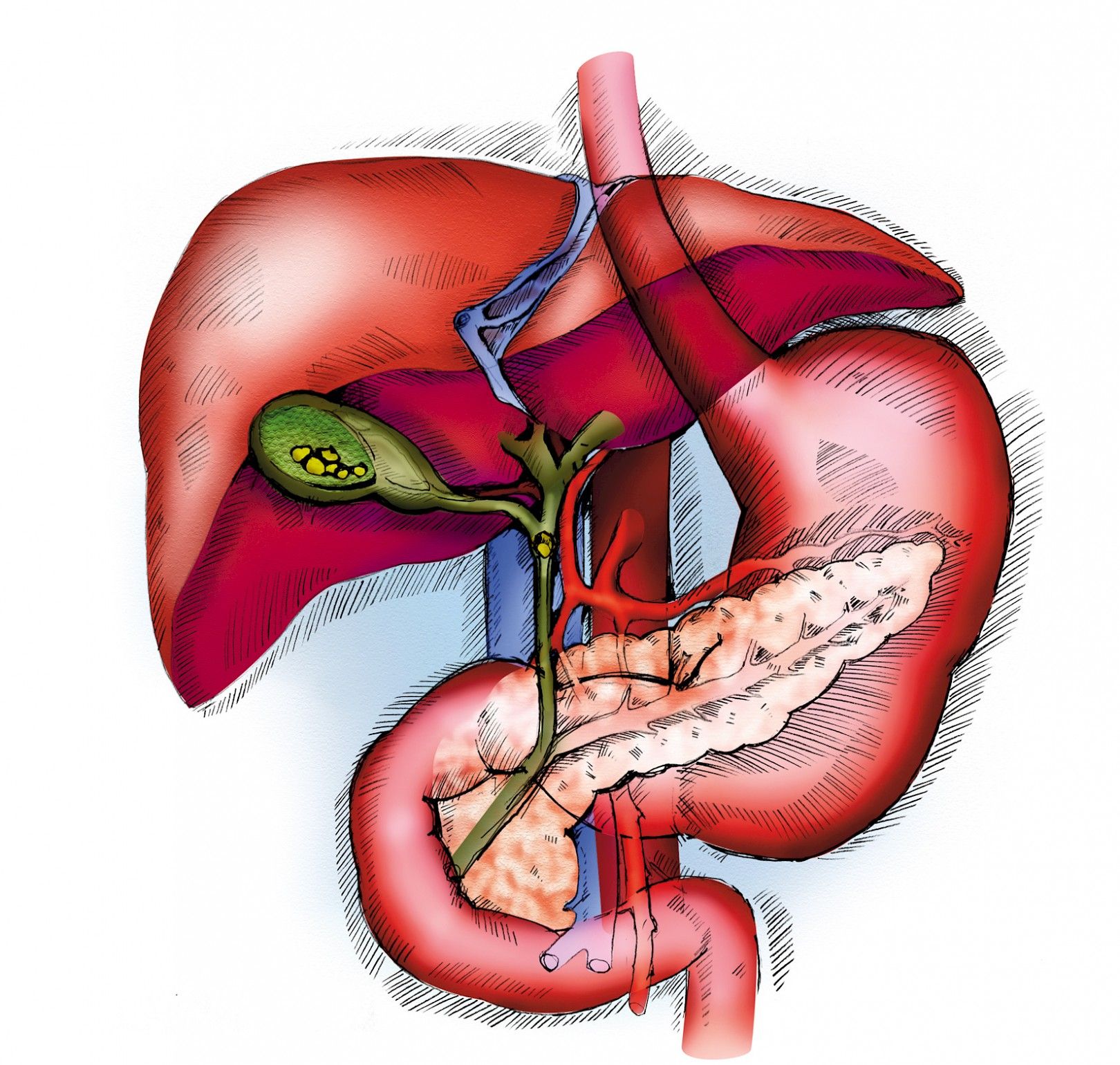 Potilaan Lääkärilehti - Sappikivet ja sappitulehdus
