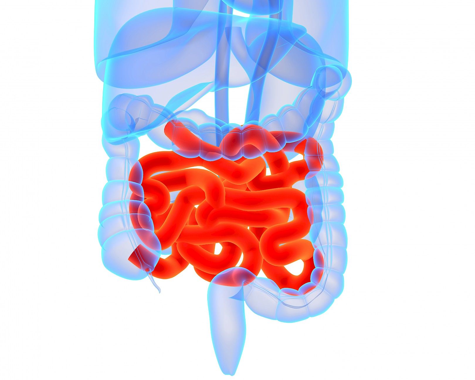 6 kysymystä: Mikä on lyhytsuolioireyhtymä? - Potilaan Lääkärilehti