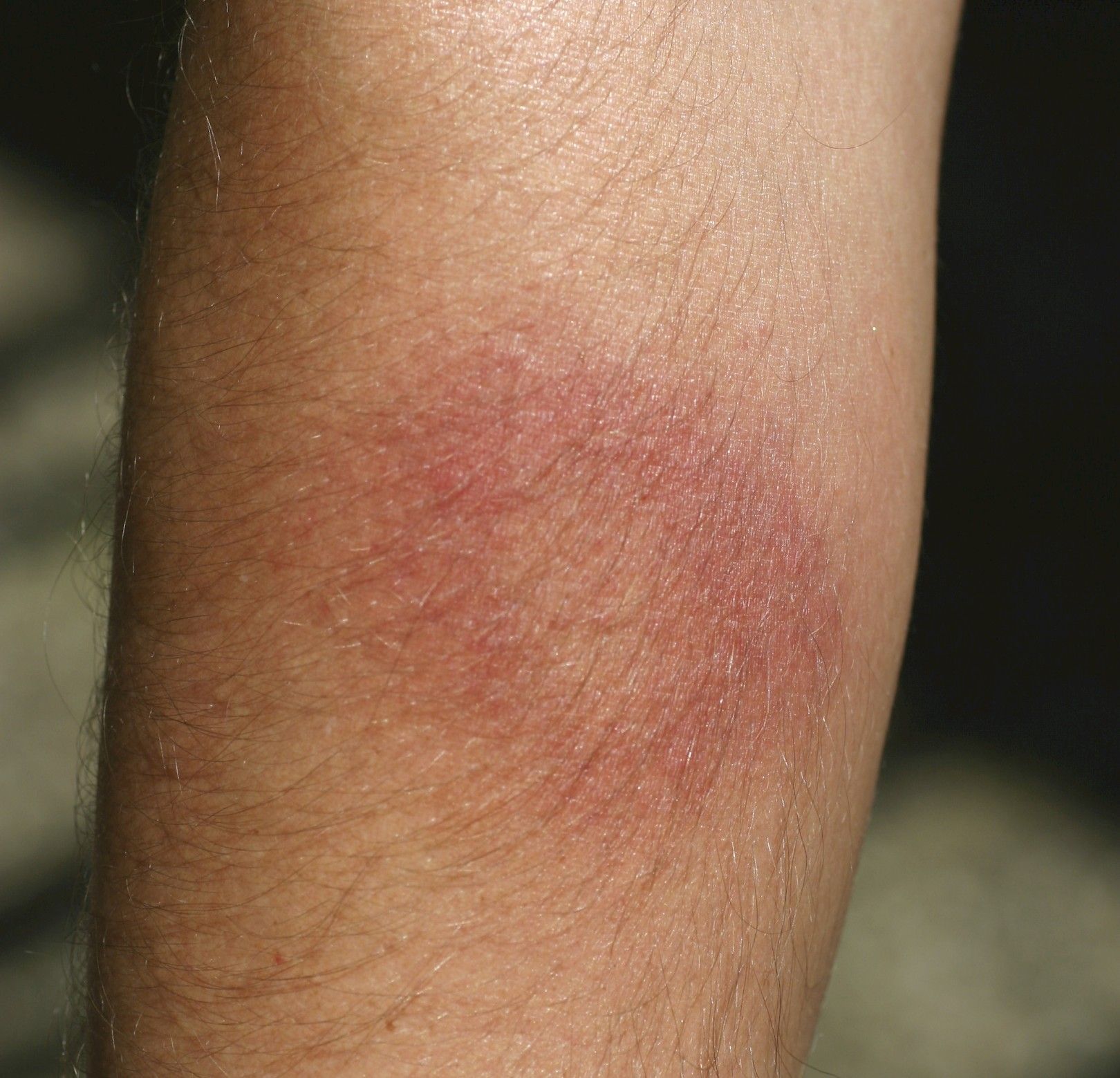 Potilaan Lääkärilehti - Mitä tiedetään levinneen borrelioosin hoidosta?